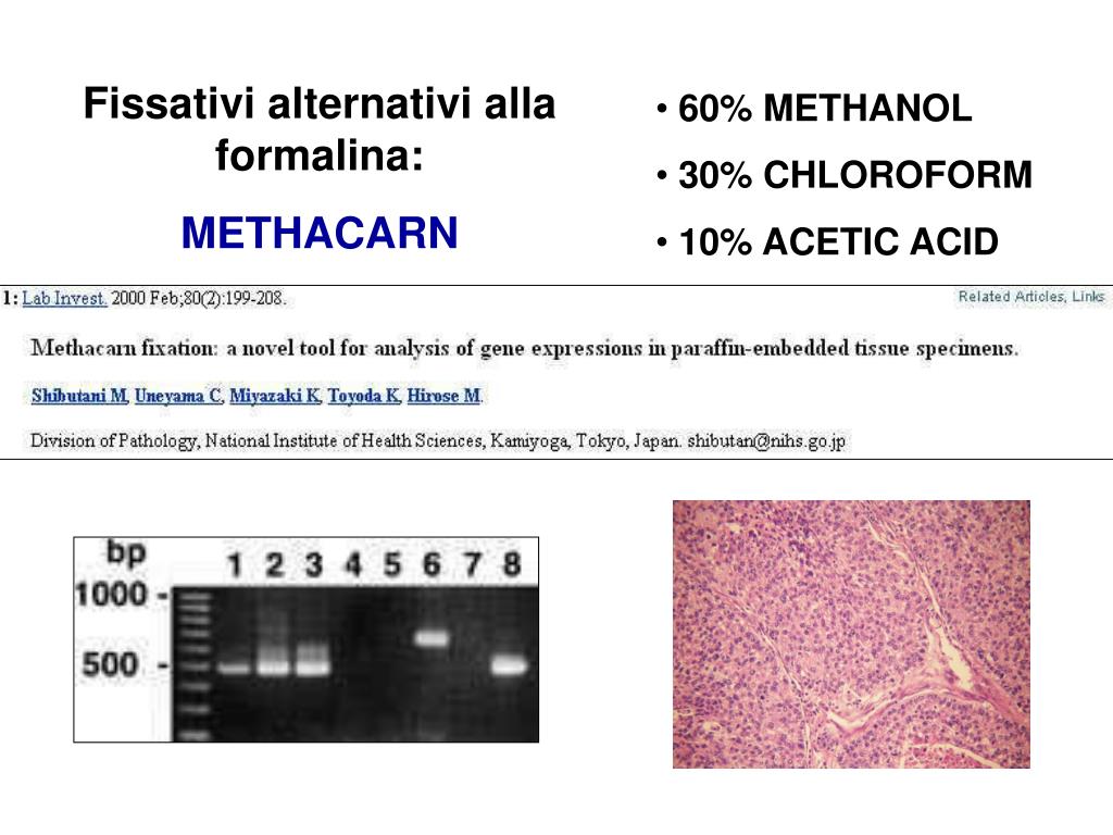 PPT - Analisi isto-patologica dei linfonodi sentinella (LNS) di ...