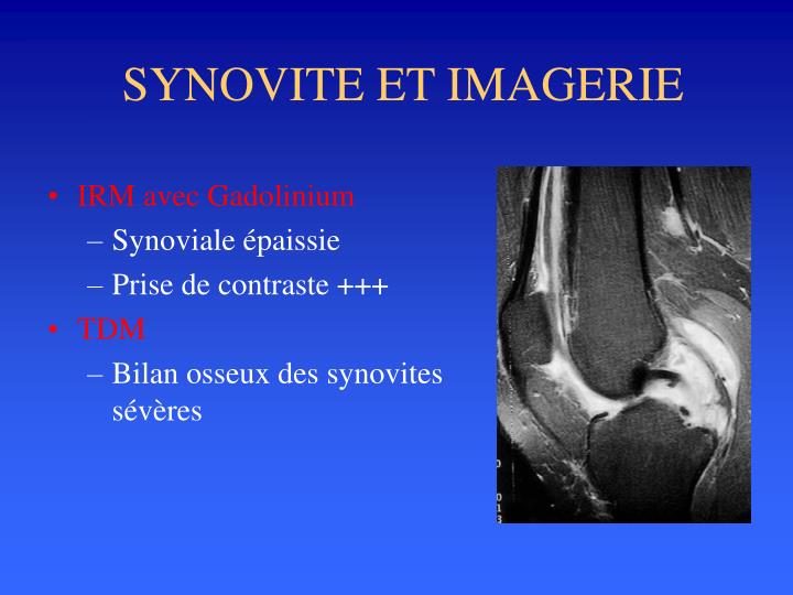 PPT - IMAGERIE DES AFFECTIONS SYNOVIALES PowerPoint Presentation - ID ...