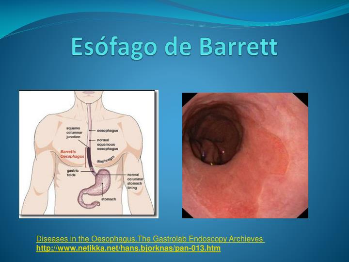 PPT - Actualización en los Síndromes Extraesofágicos de la Enfermedad ...