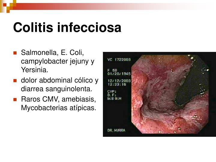 PPT - Sangrado de tubo digestivo PowerPoint Presentation - ID:968356