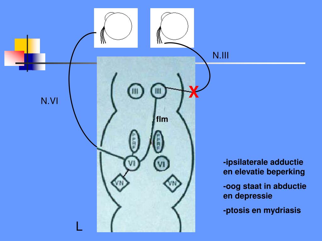 PPT - Een stoornis in geconjugeerde horizontale oogbewegingen ...