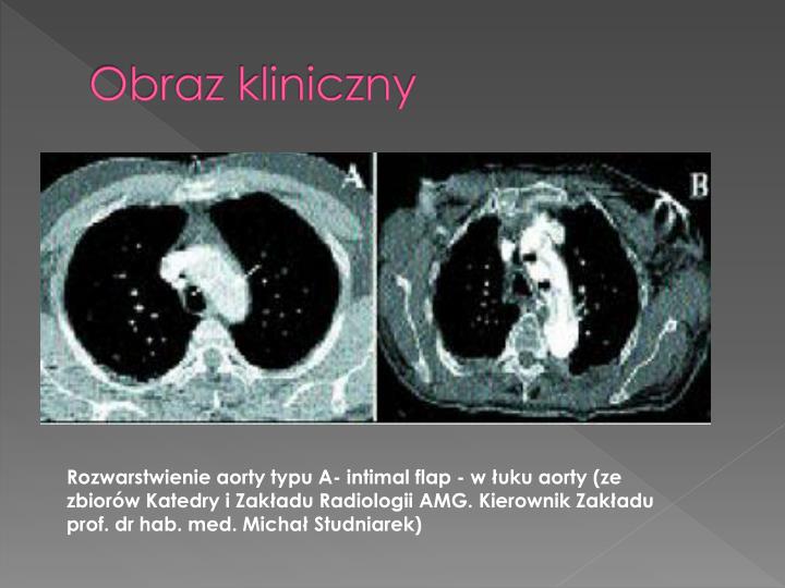 PPT - Rozwarstwienie aorty PowerPoint Presentation - ID:971462