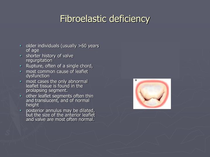 PPT - Assessing The Mitral Valve: in relation to mitral regurgitation ...
