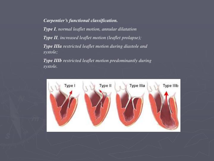 PPT - Assessing The Mitral Valve: in relation to mitral regurgitation ...