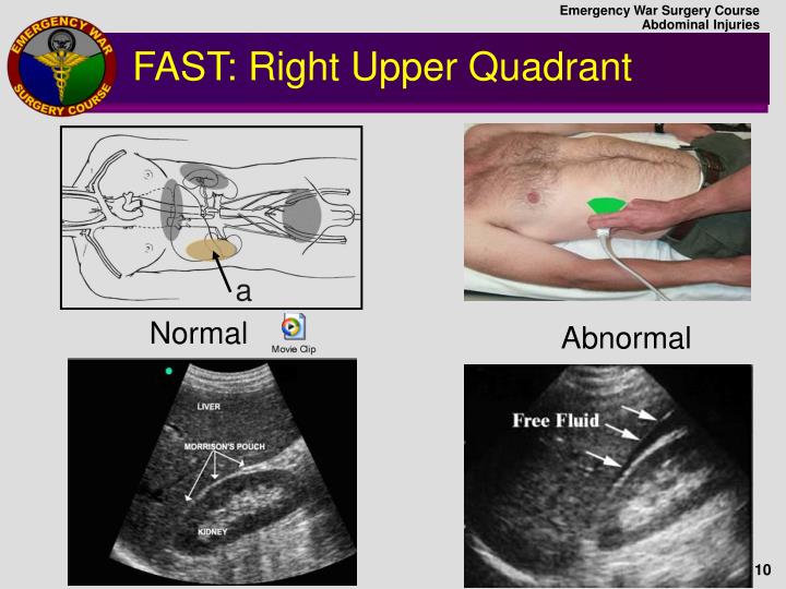 PPT - Abdominal Injuries PowerPoint Presentation - ID:976451
