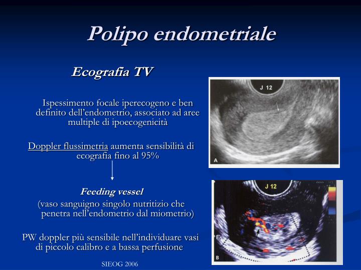 PPT - POLIPO ENDOMETRIALE PowerPoint Presentation - ID:980870