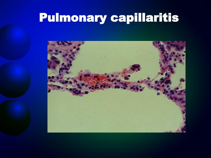 PPT - DIAGNOSIS IN DIFFUSE ALVEOLAR HEMORRHAGES PowerPoint Presentation ...