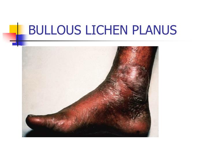 PPT - LICHEN PLANUS PowerPoint Presentation - ID:990114