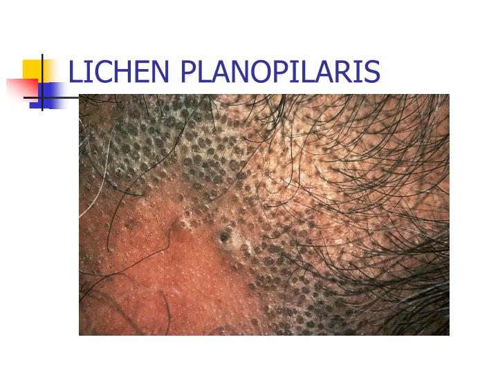 PPT - LICHEN PLANUS PowerPoint Presentation - ID:990114