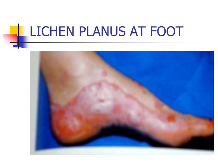 PPT - LICHEN PLANUS PowerPoint Presentation - ID:990114