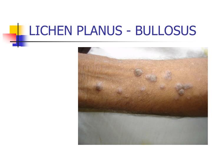 PPT - LICHEN PLANUS PowerPoint Presentation - ID:990114