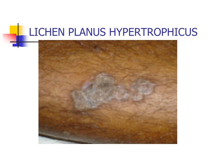 PPT - LICHEN PLANUS PowerPoint Presentation - ID:990114