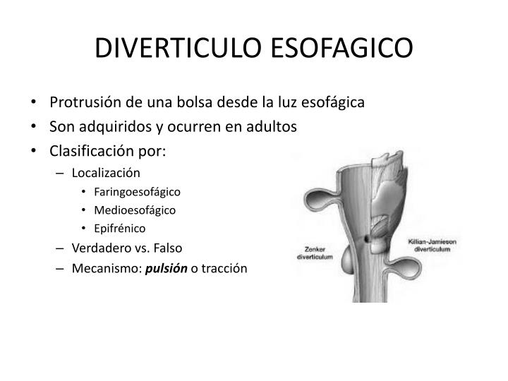 PPT - PATOLOGIA BENIGNA DEL ESOFAGO PowerPoint Presentation - ID:993440