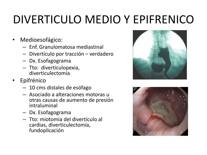 PPT - PATOLOGIA BENIGNA DEL ESOFAGO PowerPoint Presentation - ID:993440