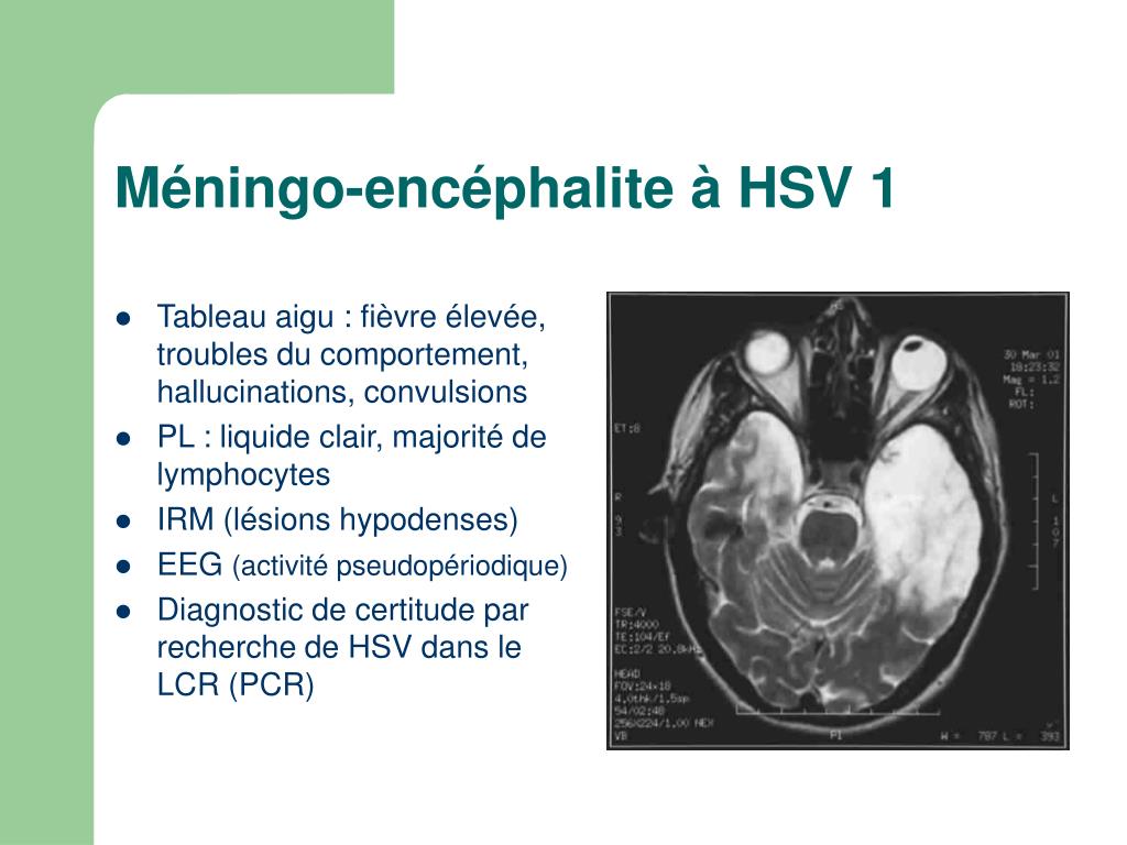 PPT - Méningites et Méningo-encéphalites PowerPoint Presentation, free ...