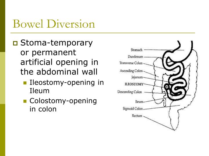 PPT - Bowel Diversion: Ostomies PowerPoint Presentation - ID:998577