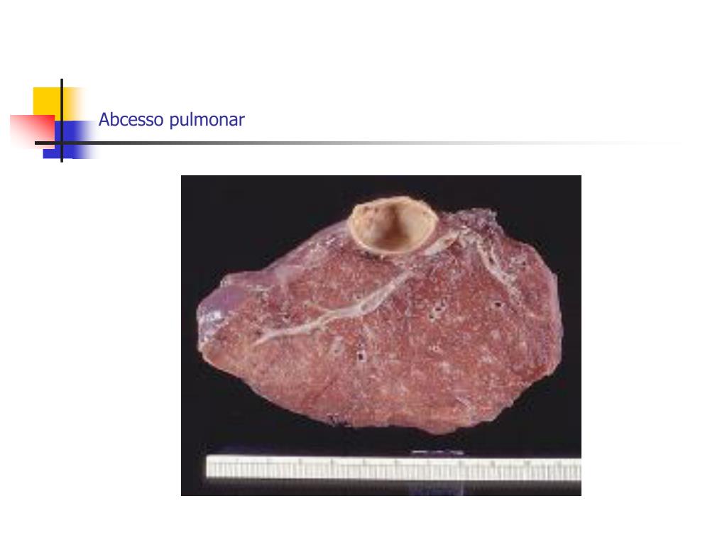 PPT - INFECÇÕES RESPIRATÓRIAS AGUDAS NA INFÂNCIA PowerPoint ...