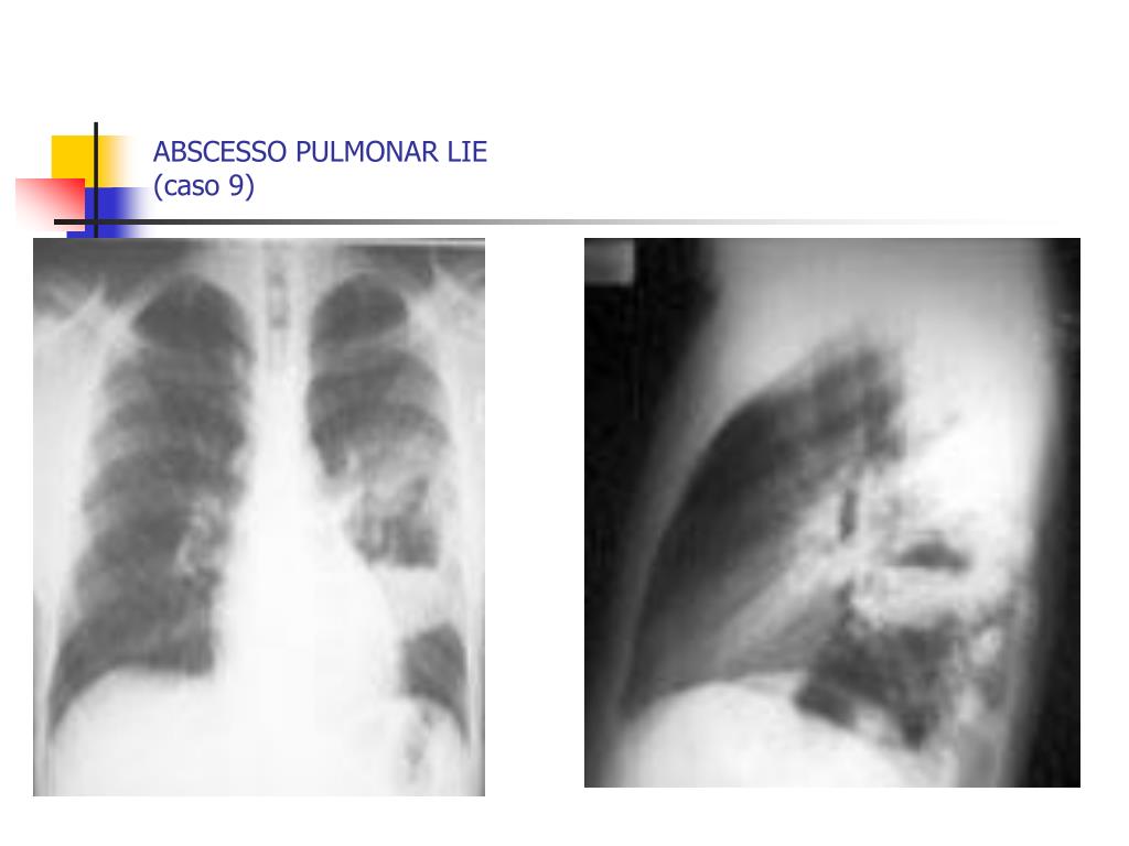 PPT - INFECÇÕES RESPIRATÓRIAS AGUDAS NA INFÂNCIA PowerPoint ...